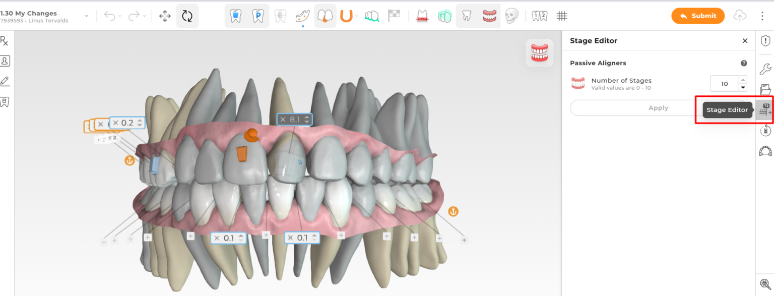 Spark™ Releases – Die neuesten Updates zu Spark Alignern